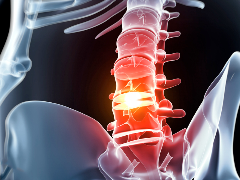 Surgery Conditions and Treatments Atlanta, GA | Legacy Brain and Spine